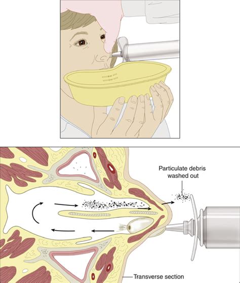 Foreign Body Nose Anesthesia Key