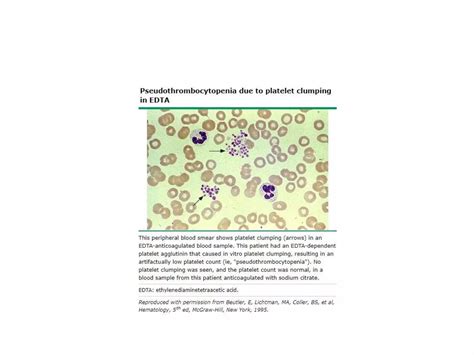 Approach To Thrombocytopenia Pptx