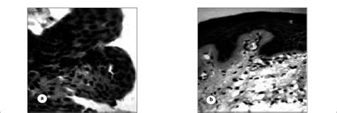 Histopathologic Features Of Remission Specimens Of Recurrent