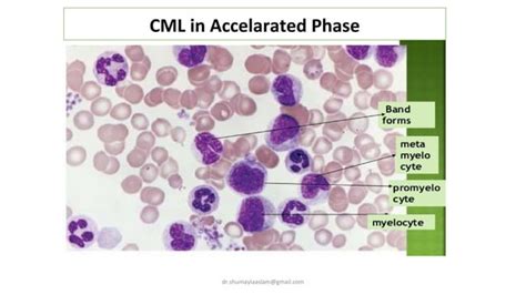 Chronic Myeloid Leukemia Cml