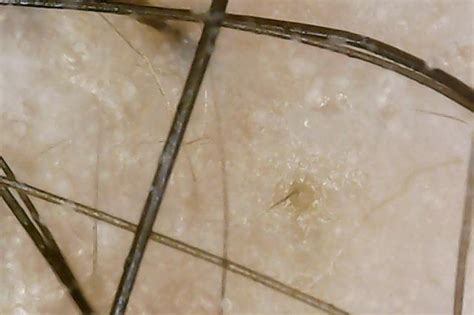 Hair Loss Under A Microscope You Can See The Extremely Miniaturized Hair Follicle R
