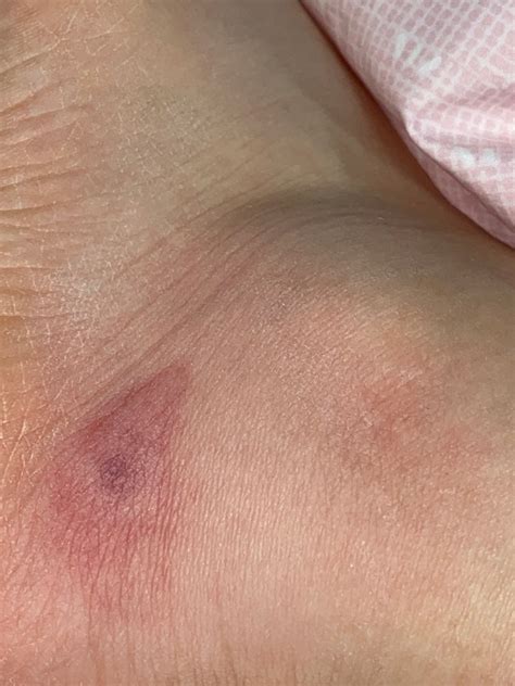 모기 물린 곳 멍 지식in