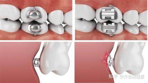 轻舒适化矫正方案：构建正畸行业的舒适化体验生态系统 知乎