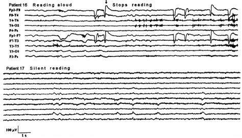 Partial Seizure Eeg