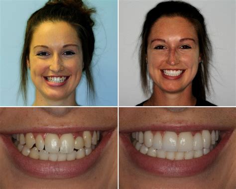 Porcelain Veneers Cost Per Tooth