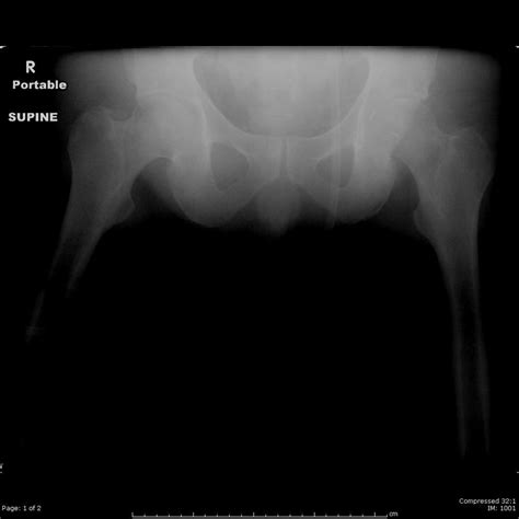 Femoral Head Fractures Trauma Orthobullets