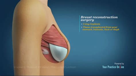breast cancer surgery reconstruction