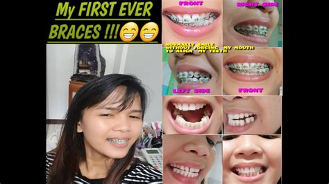 First Braces In History At Fred Rollins Blog