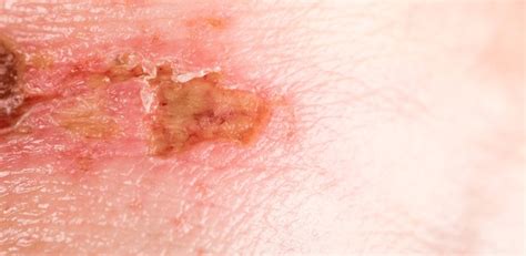 Battery Acid On Skin