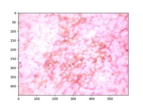 Github Yakeshkarthikey Skin Disease Detection Using Based On Deep Learning Technique A Skin