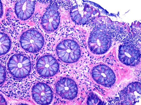 Image Of Ulcerative Colitis Mild Form With A Moderate Inflammatory Download Scientific
