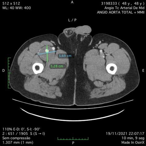 Angio Ct Scan In Axial Incidence Showing Deep Femoral Artery Aneurysm