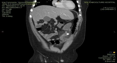 Ct Showing Left Sided Appendicitis With Appendicolith Download Scientific Diagram