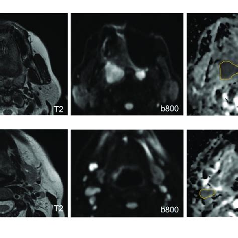 Hpv Negative Opscc In A 72 Year Old Non Smoker Non Alcoholic Male Mri Download Scientific