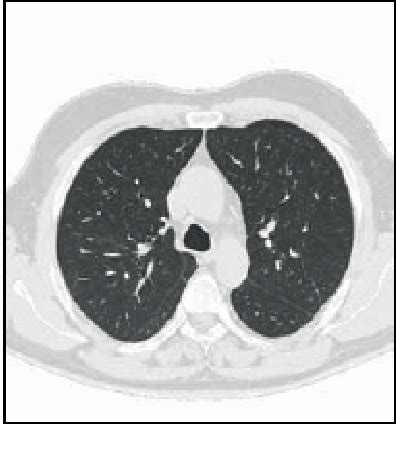 Figure From Automated CAD For Lung Nodule Detection Using CT Scans Semantic Scholar