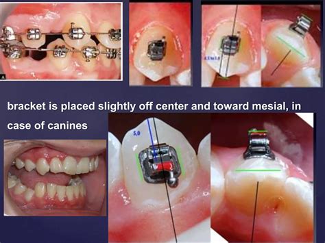 Placement Of Orthodontic Brackets Pptx Dental Health Diseases And Conditions
