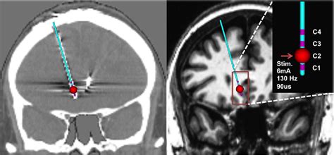Figure 1 From Mapping The Depression Switch During Intraoperative