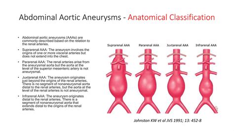 Endovascular Surgery Of Abdominal Aorta Ppsx
