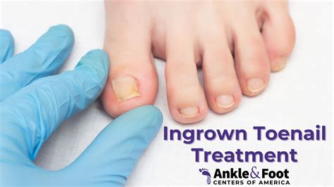 Ingrown Toenail Treatment Ankle And Foot Centers Of America