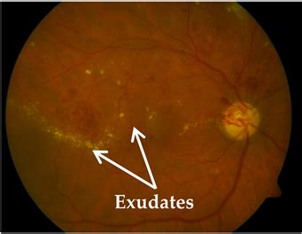 Automated Exudates Detection In Retinal Fundus Image Using
