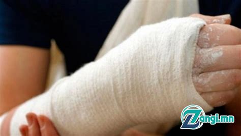 Zangi Mn Осол гэмтлийн 35 40 хувийг хальтирч унаснаас үүдэлтэй бэртэл эзэлдэг байна