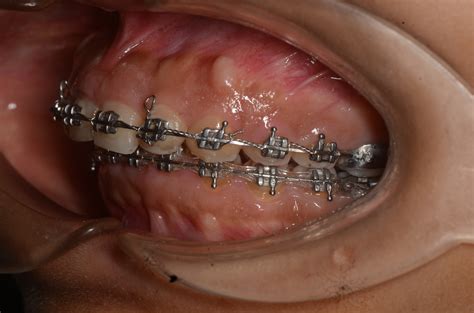 Dentosphere World Of Dentistry Fenestration As An Adverse Effect Of