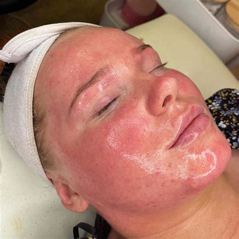 My Skin Looks Worse After Chemical Peel Is That Normal