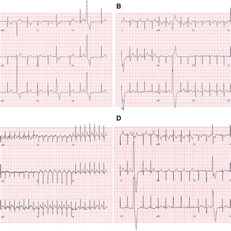 Suppression With Exercise 12 Lead Ecg During Treadmill Exercise Download Scientific Diagram