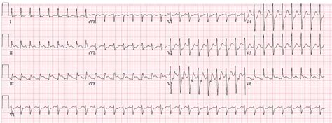 Arrhythmia Ischemia Both Electricity Drugs Lytics Cath Lab You Decide Dr Smiths Ecg Blog