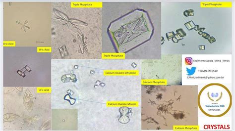 Basic Calcium Phosphate Crystals