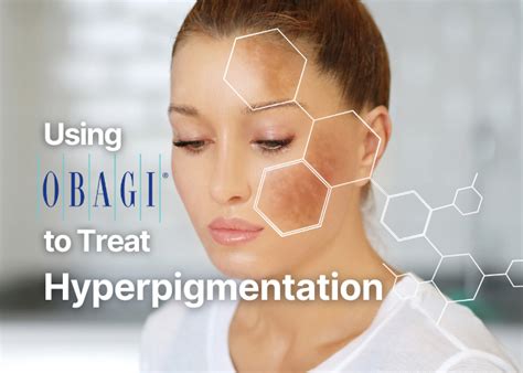 Using Obagi To Treat Hyperpigmentation Skin Deep Professional