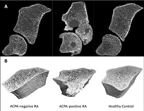 High Resolution Peripheral Quantitative Computed Tomography Hr Pqct