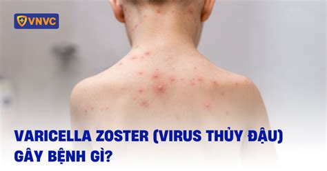 Varicella Zoster Virus Thủy đậu Gây Bệnh Gì Cách Phòng Ngừa Varicella Zoster Virus Thủy đậu Gây Bệnh Gì Cách Phòng Ngừa