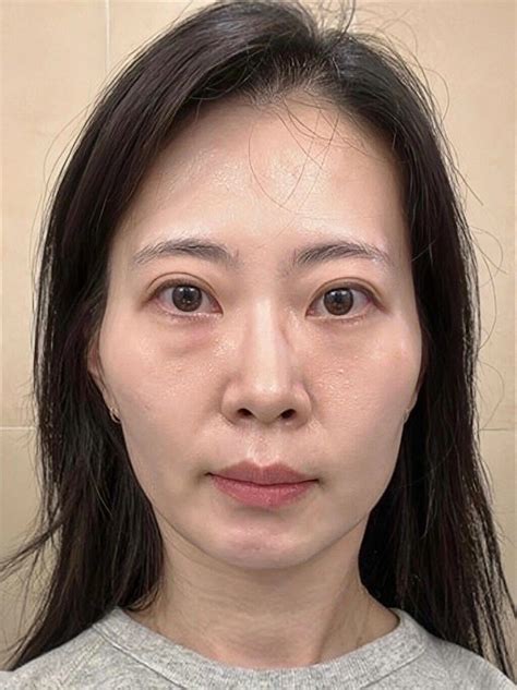 有被嚇爛🤯客人來做了個全臉提升 25年才47歲 花了個包包的錢 客人非常開心這個變化 大家幫忙看看這值得嗎🥹醫美