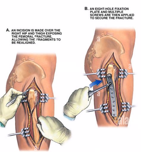 Open Reduction And Closed Reduction Internal Fixation Pros And Cons
