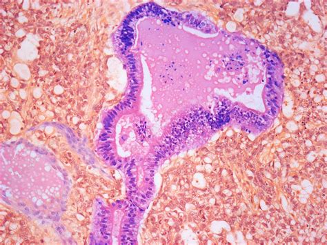 Yolk Sac Tumour Light Micrograph Stock Image C021 0454 Science Photo Library