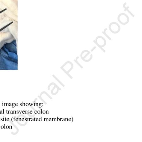 Intra Operative Images Showing Dilated Stomach And Proximal Duodenum