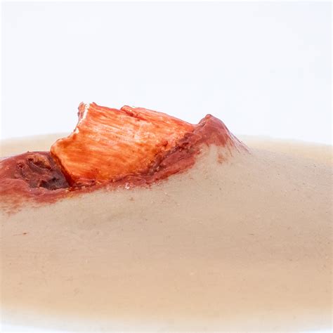 Open Fracture Mediquip