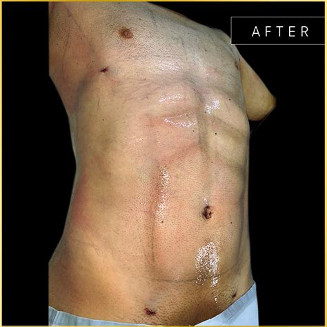 Before And After Liposser