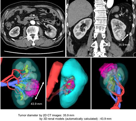 Simplified Padua Renal Spare Nephrometry System Can Describe The Surgical Difficulty Of Renal