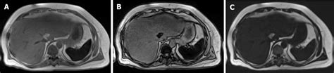 Fatty Liver Mri