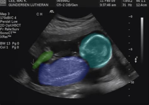 Github Yoavalonultrasoundsegmentation Simple Obstetric Ultrasound Segmentation Of Brain
