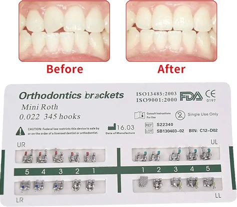 Brackets Mini Roth Ortodoncia Cómoda Y Estética Iccsi