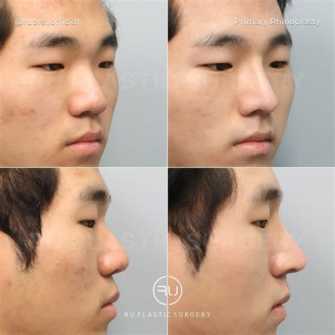 알유성형외과 코재수술·자가늑연골코성형·구축코·안면윤곽·리프팅 Ruprsofficial • Instagram Photos And Videos