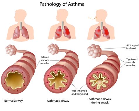 Asthma Allergy And Asthma Consultants Llp Dba Charleston Allergy And