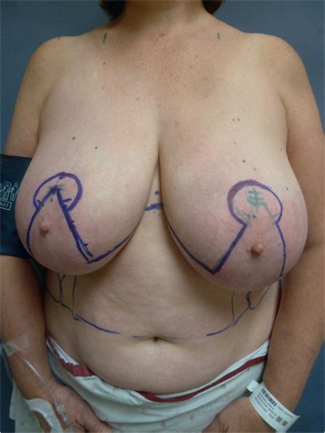 72 Wise Pattern Breast Reduction Plastic Surgery Key