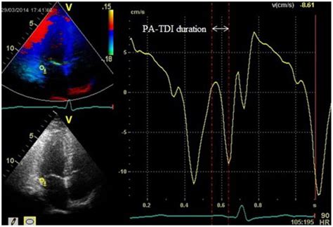 Relationship Of The Total Atrial Conduction Time To Subclinical