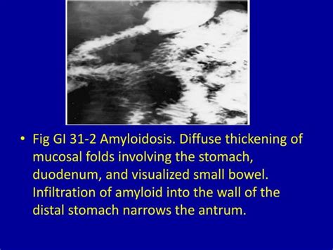 31 Simultaneous Fold Thickening Of The Stomach And Pptx
