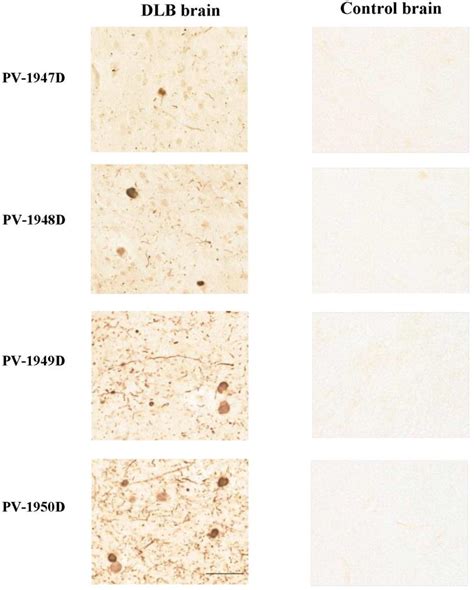 Multitep Platform Based Dna Vaccines For Alpha Synucleinopathies