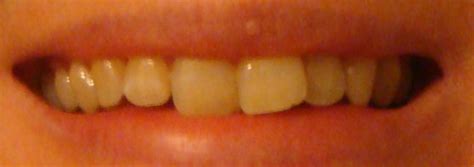 How Clear Are Invisaligns